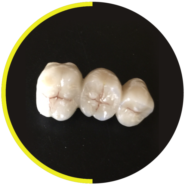 Porcelain Fused to Metal – DENTAL ART STUDIO